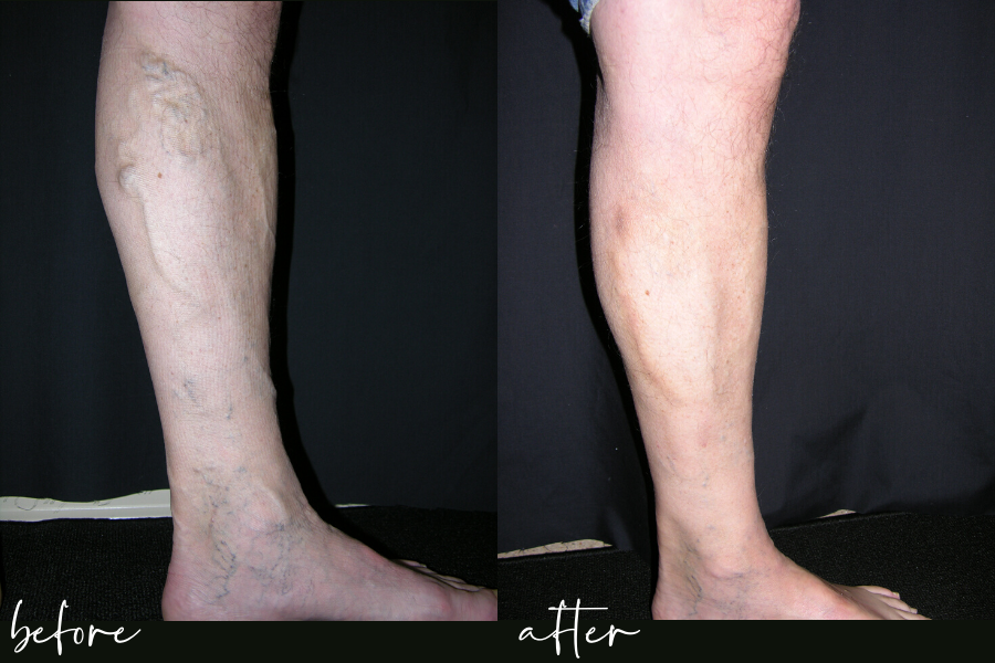 Before After The Vein Centre Therapy Treatment Gallery
