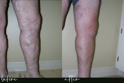 Before & After | The Vein Centre Therapy & Treatment Gallery