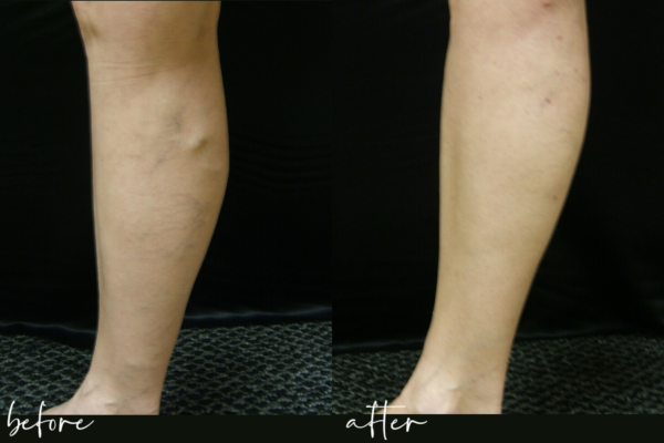 Before & After | The Vein Centre Therapy & Treatment Gallery