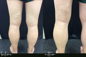 Before & After | The Vein Centre Therapy & Treatment Gallery