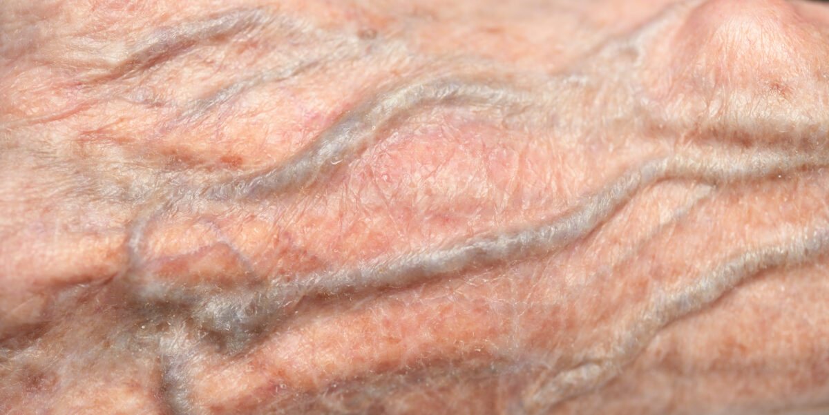 Visible Hand Veins and Why You Have Them | The Vein Centre