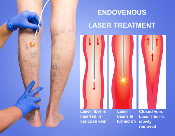 Endovenous Laser for Varicose Veins: What to Know | The Vein Centre